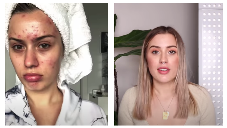 Stories of treatment | Heliotherapy Research Institute