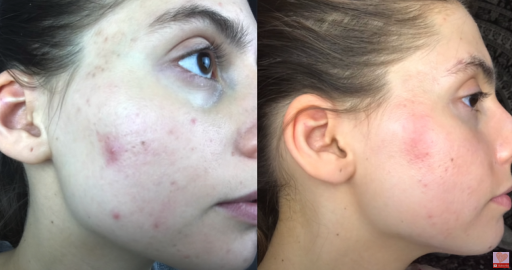 Stories of treatment | Heliotherapy Research Institute