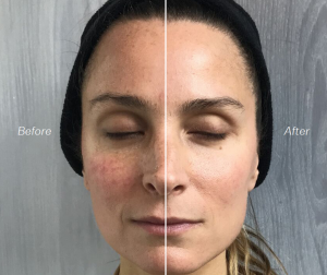 Cryoskin Therapy: Before & After, Pros & Cons, And Clinical Studies ...