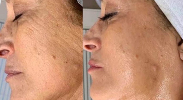 Cryoskin Treatment: Full Review & Reasons To Do (Or Not) | Heliotherapy ... Cryoskin Treatment: Full Review & Reasons To Do (Or Not) | Heliotherapy ...