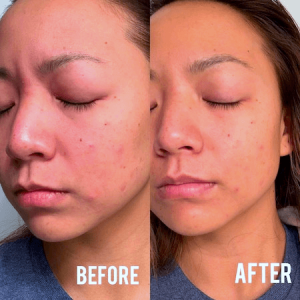 NuDerma Wand: Does It Really Work? Doctor’s Opinion + Reviews | Heliotherapy Research Institute