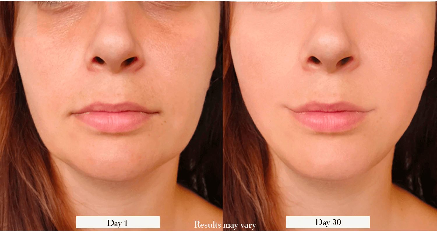 NuDerma Wand: Does It Really Work? Doctor’s Opinion + Reviews ...