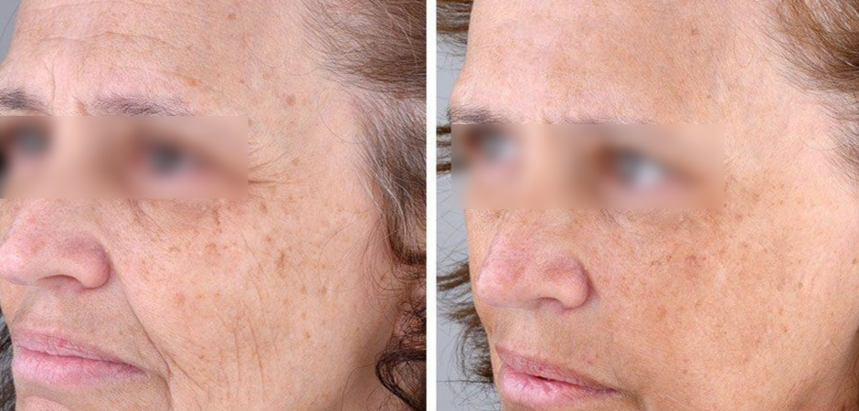 4 Best Medical-grade Red Light Therapy Devices for Home Use ...